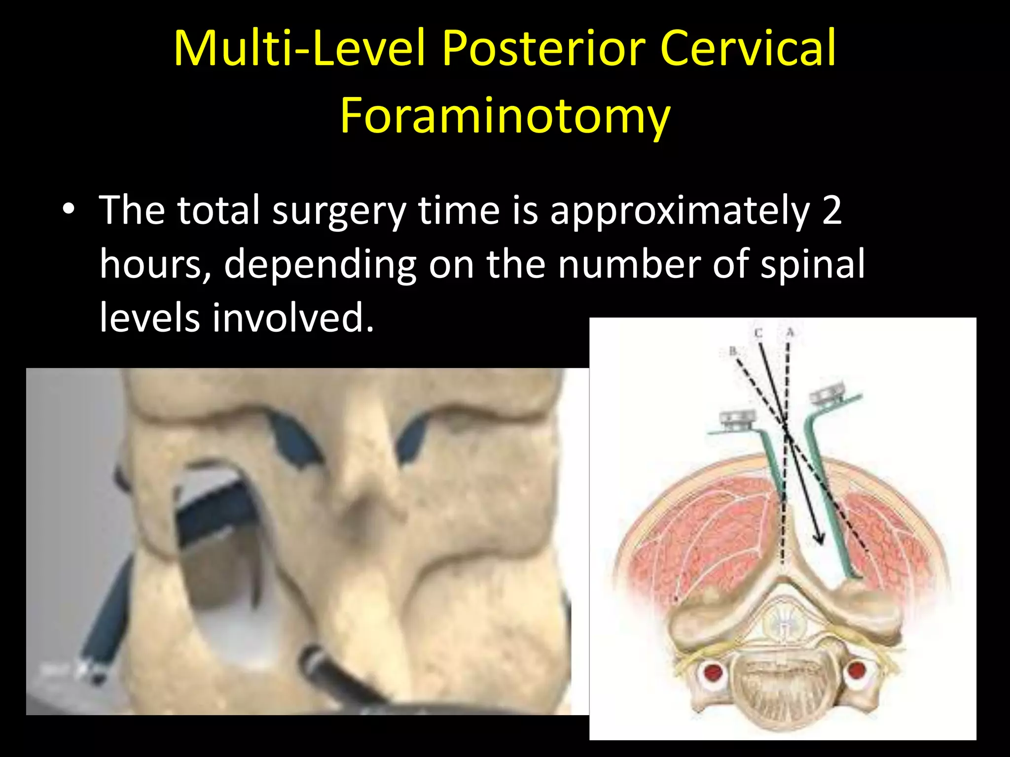 Posterior foraminotomy for cervical disc herniation | PPTX