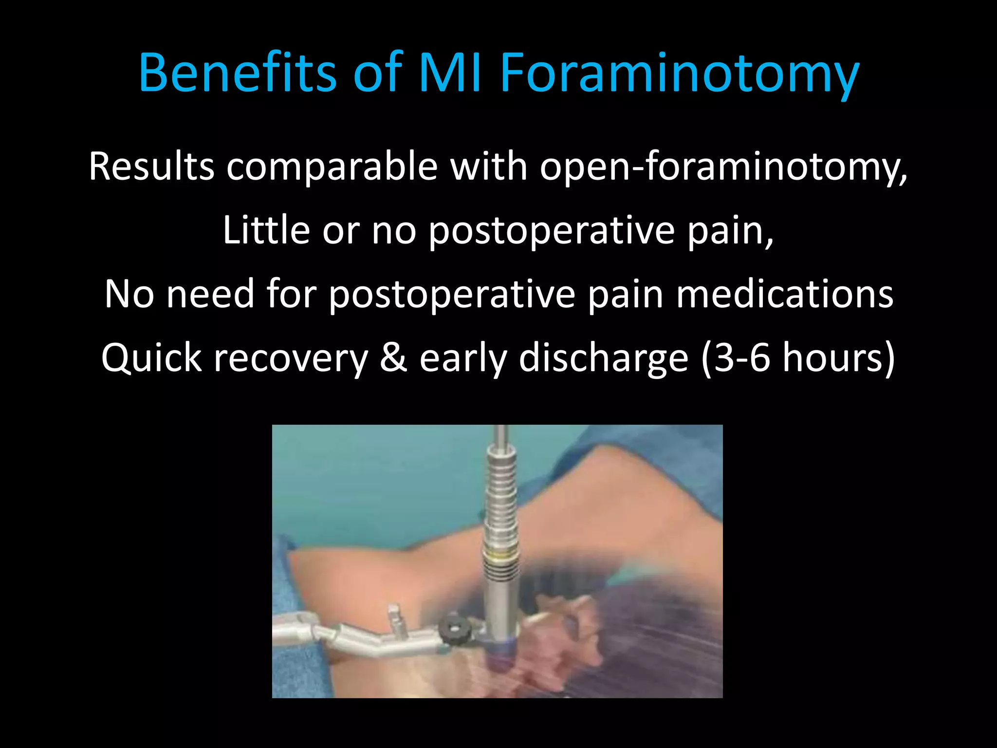 Posterior foraminotomy for cervical disc herniation | PPTX