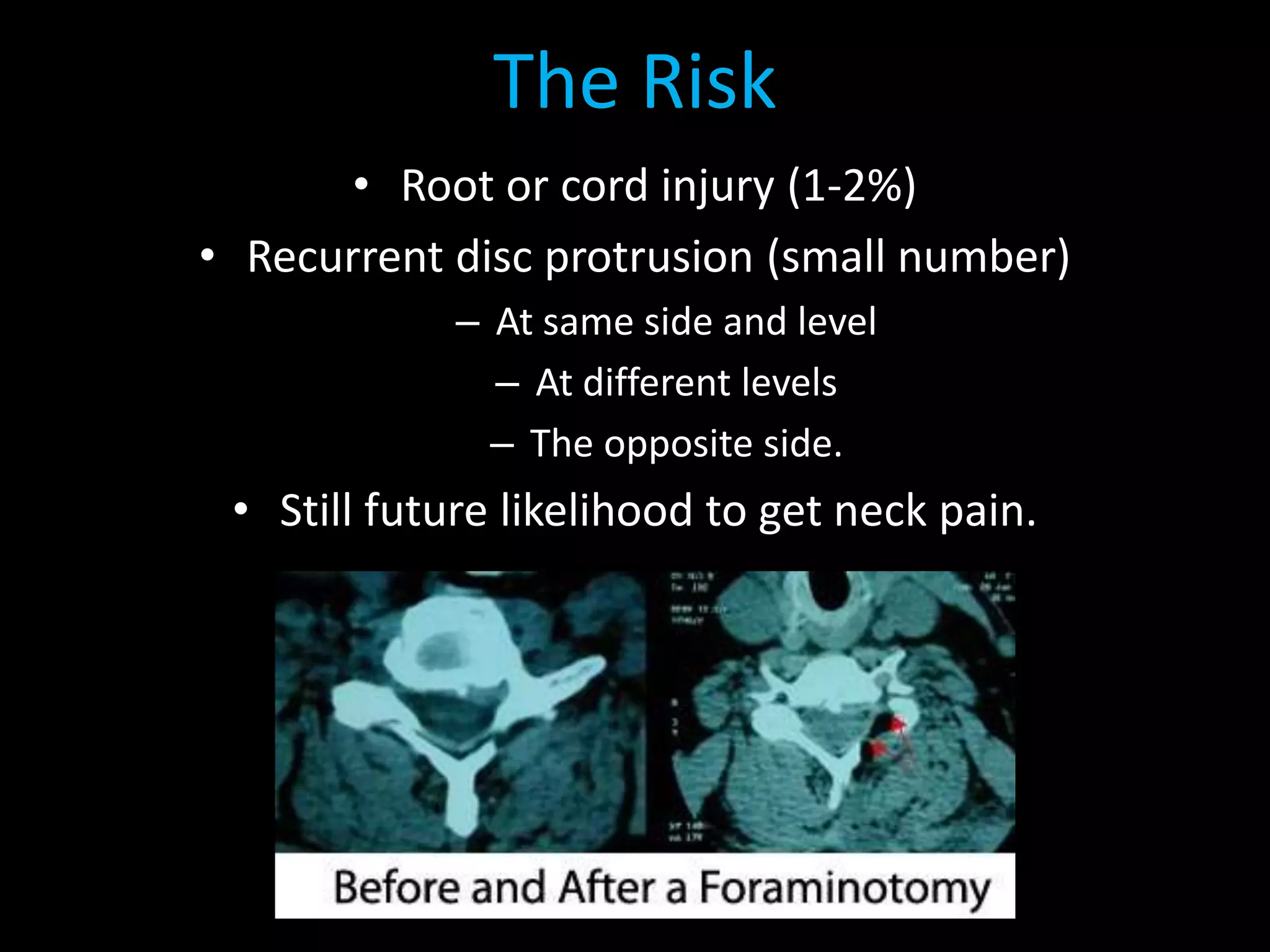 Posterior foraminotomy for cervical disc herniation | PPTX