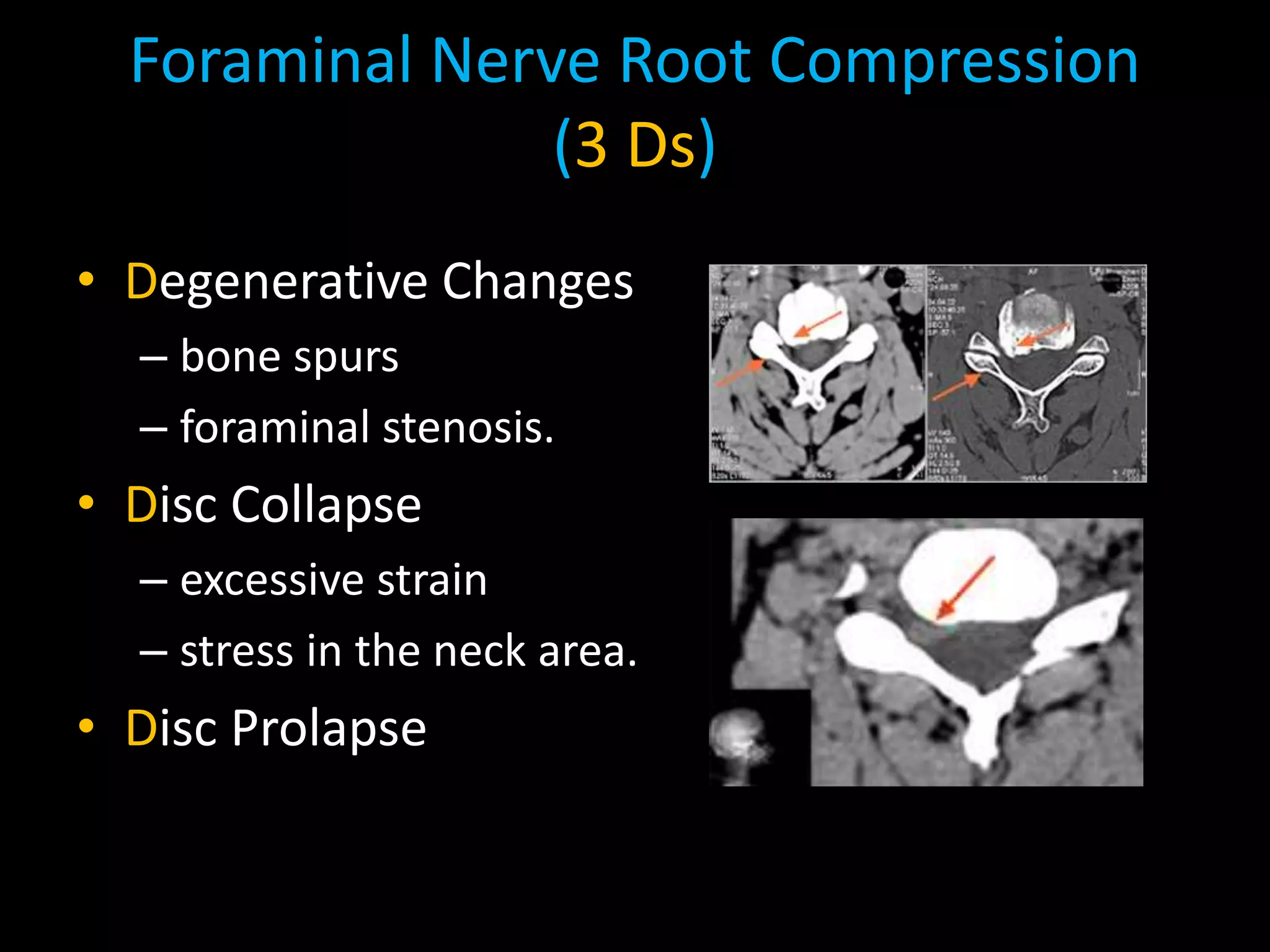 Posterior foraminotomy for cervical disc herniation | PPTX
