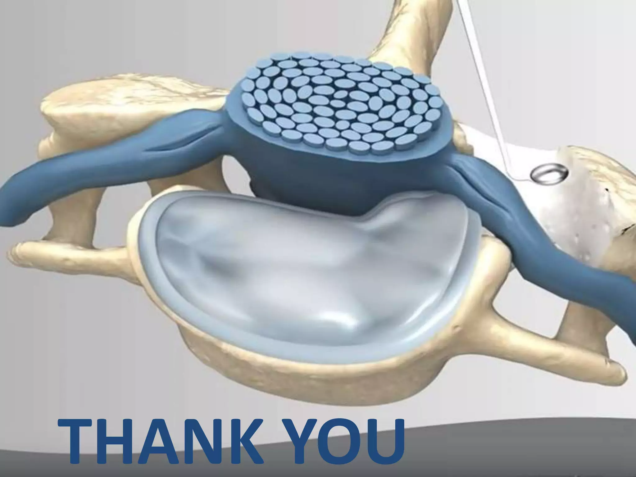 Posterior foraminotomy for cervical disc herniation | PPTX