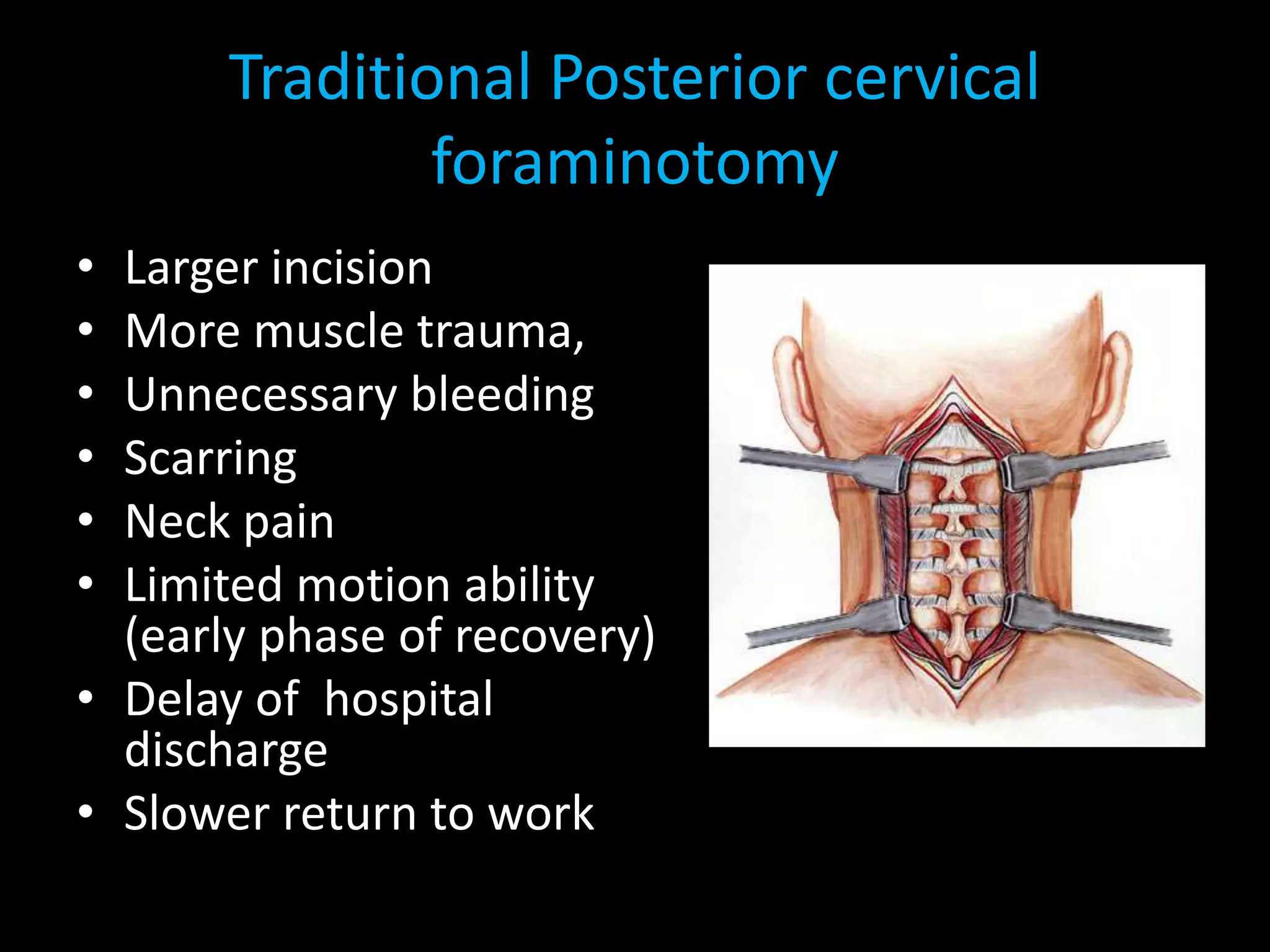 Posterior foraminotomy for cervical disc herniation | PPTX
