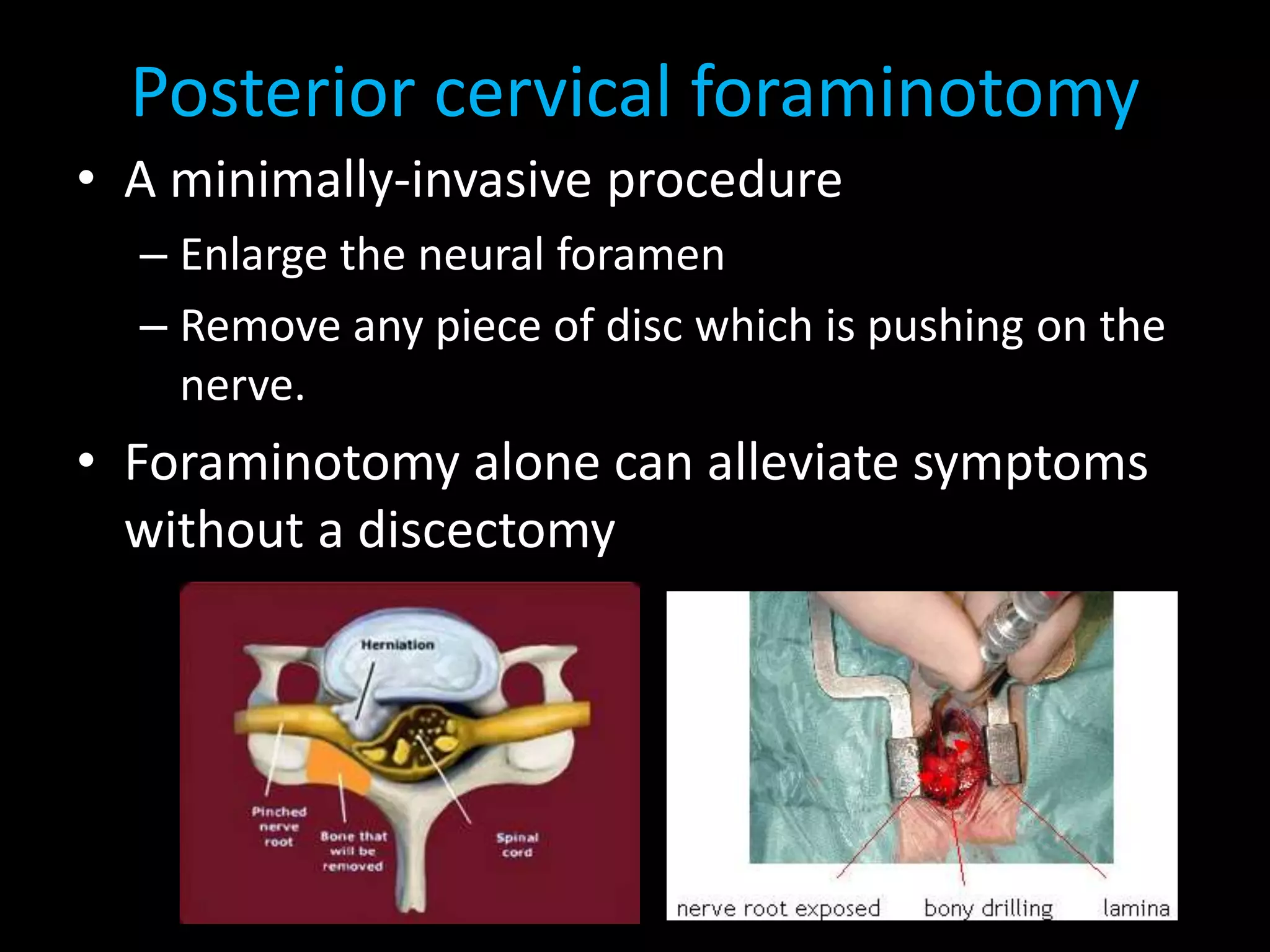 Posterior foraminotomy for cervical disc herniation | PPTX