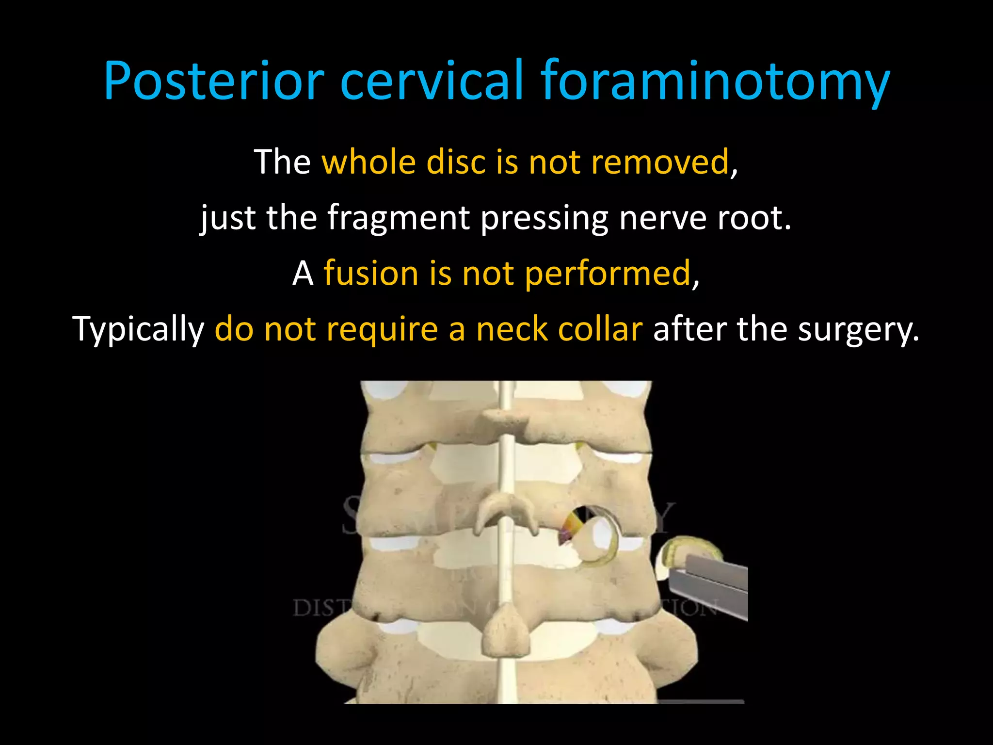 Posterior foraminotomy for cervical disc herniation | PPTX