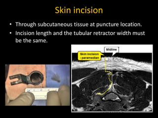 Posterior foraminotomy for cervical disc herniation | PPTX