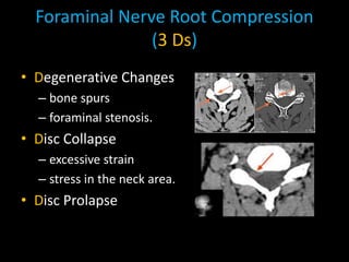 Posterior foraminotomy for cervical disc herniation | PPTX