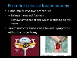 Posterior foraminotomy for cervical disc herniation | PPTX