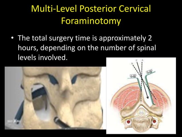 Posterior foraminotomy for cervical disc herniation