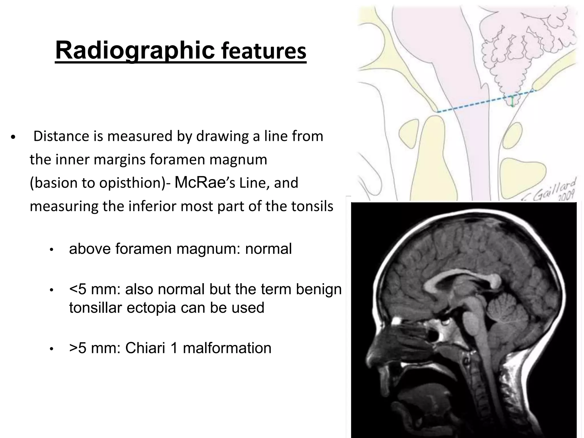 Posterior fossa malformations | PPTX