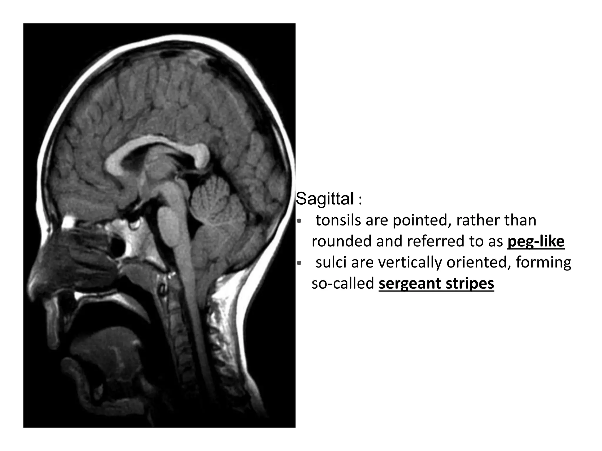Posterior fossa malformations | PPTX
