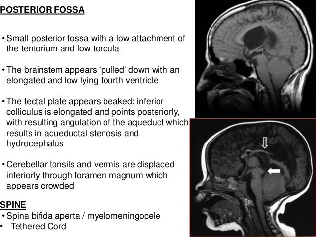 Posterior fossa malformations