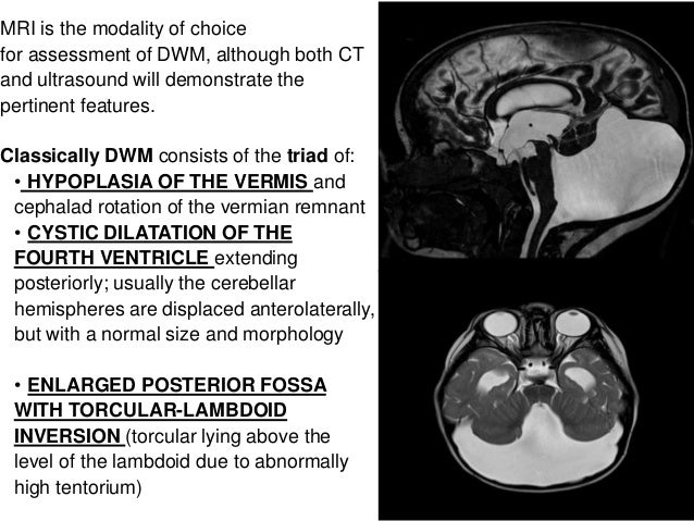 Posterior fossa malformations