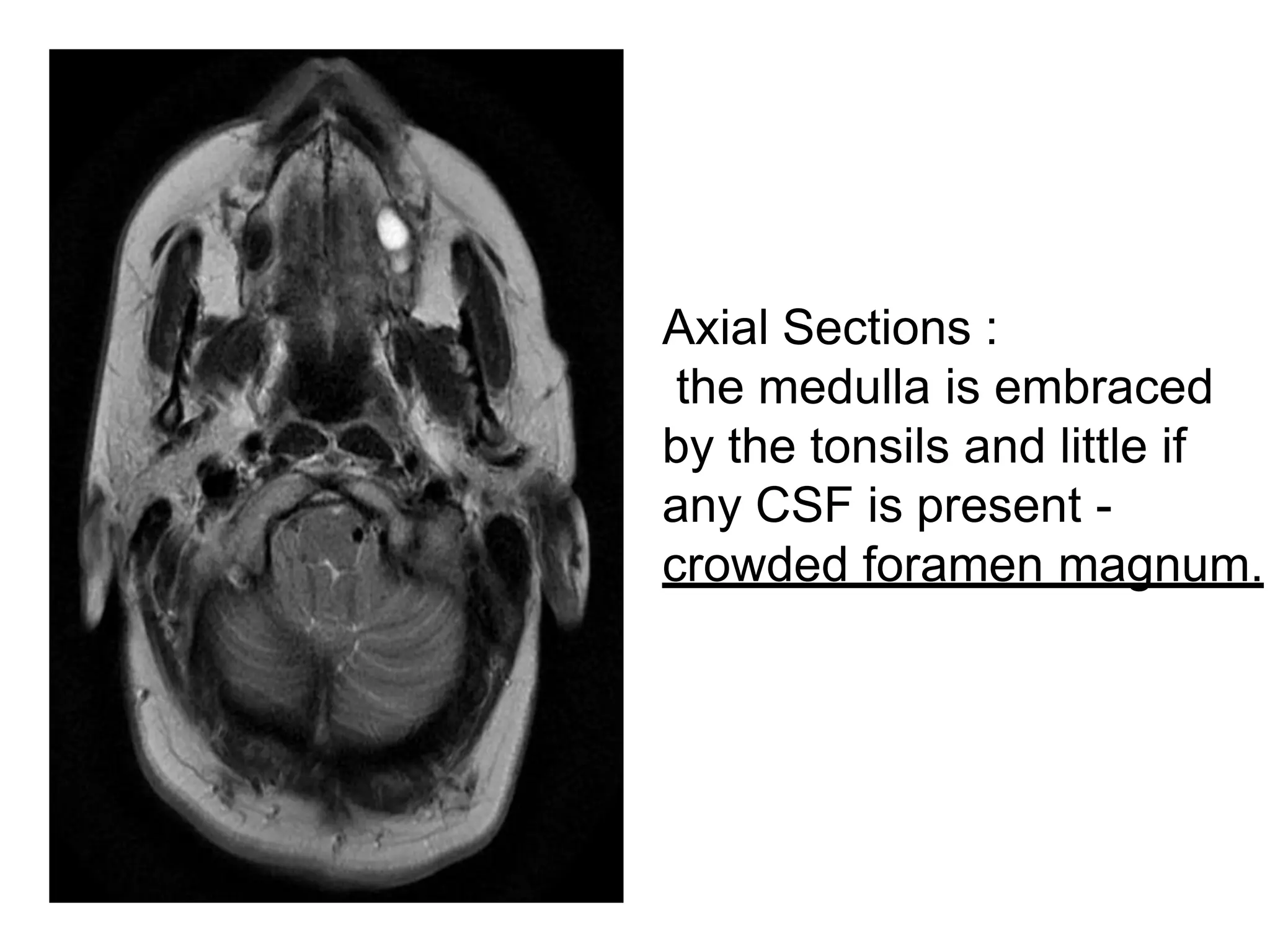 posteriorfossamalformations-170608150351 (1).pptx
