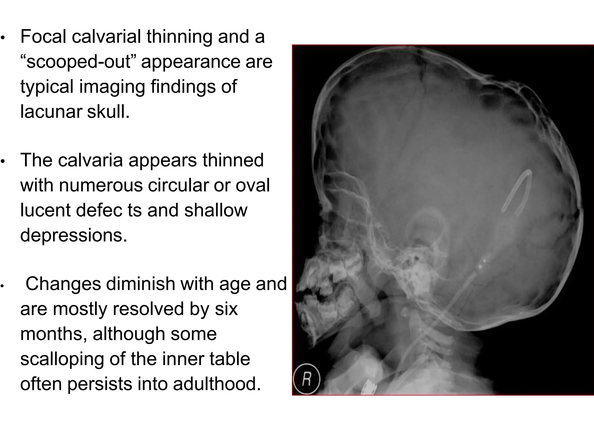 posteriorfossamalformations-170608150351 (1).pptx