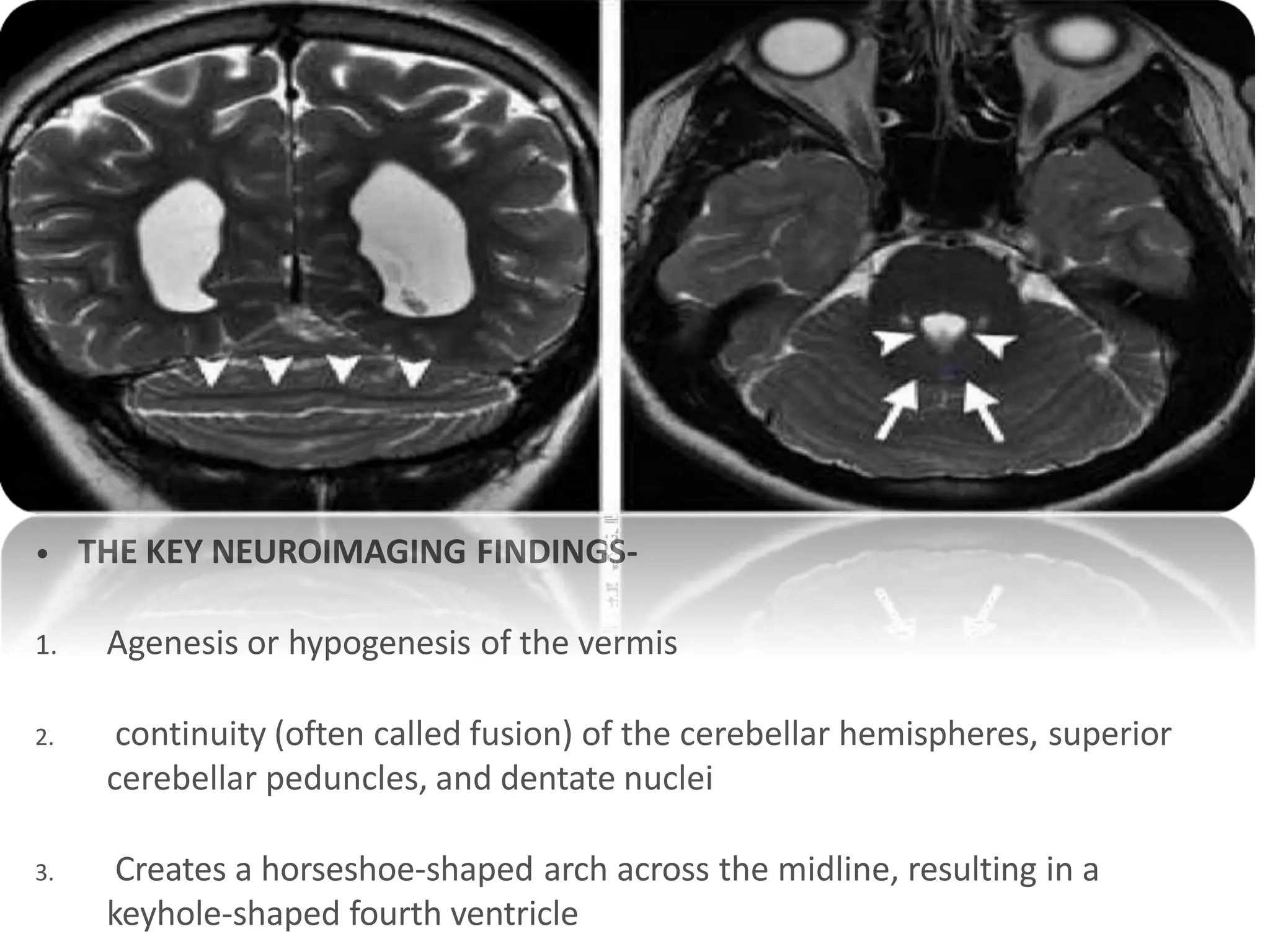 posteriorfossamalformations-170608150351 (1).pptx