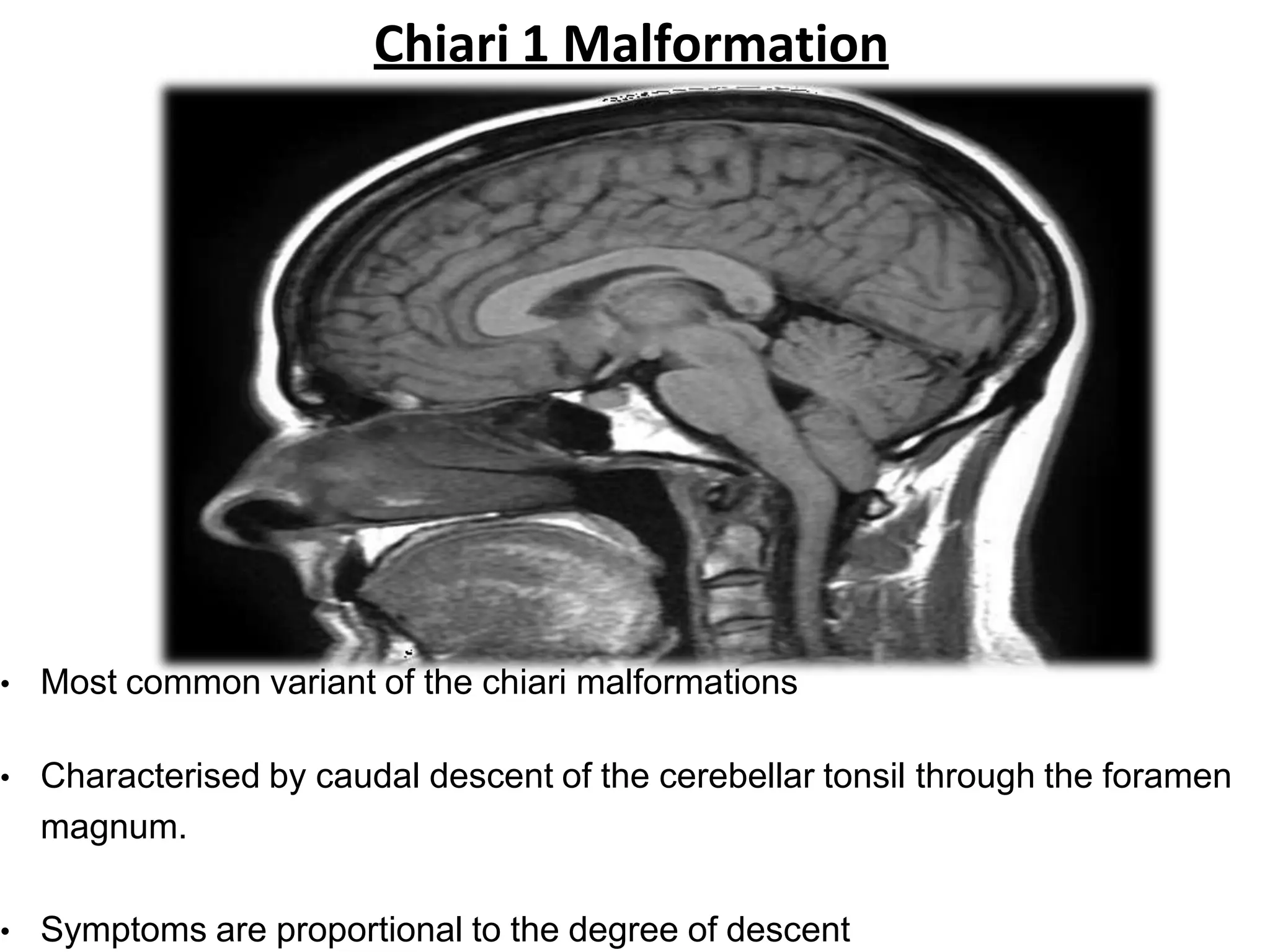 posteriorfossamalformations-170608150351 (1).pptx