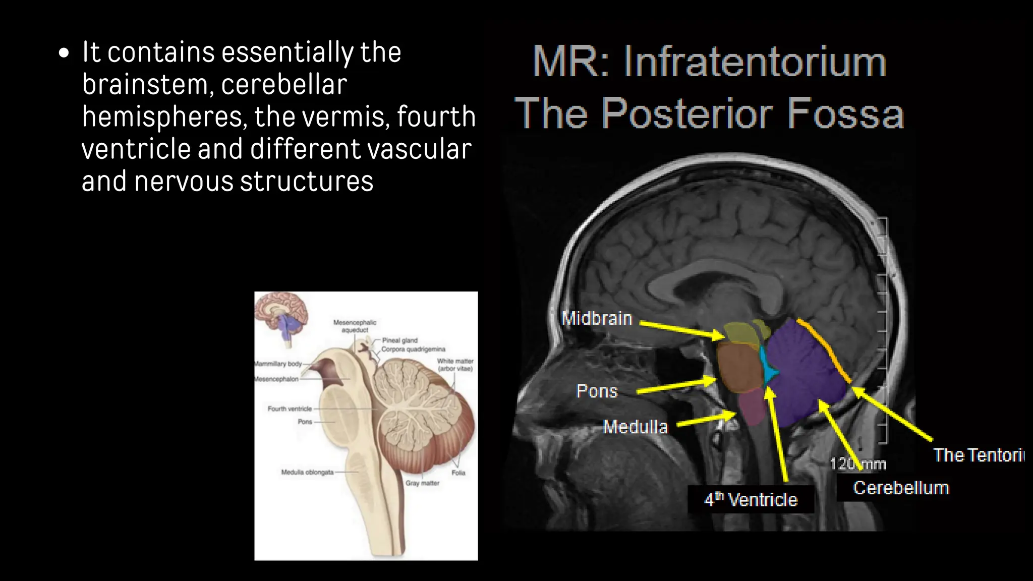 Posterior fossa tumours - Head and neck radiology pdf | PDF