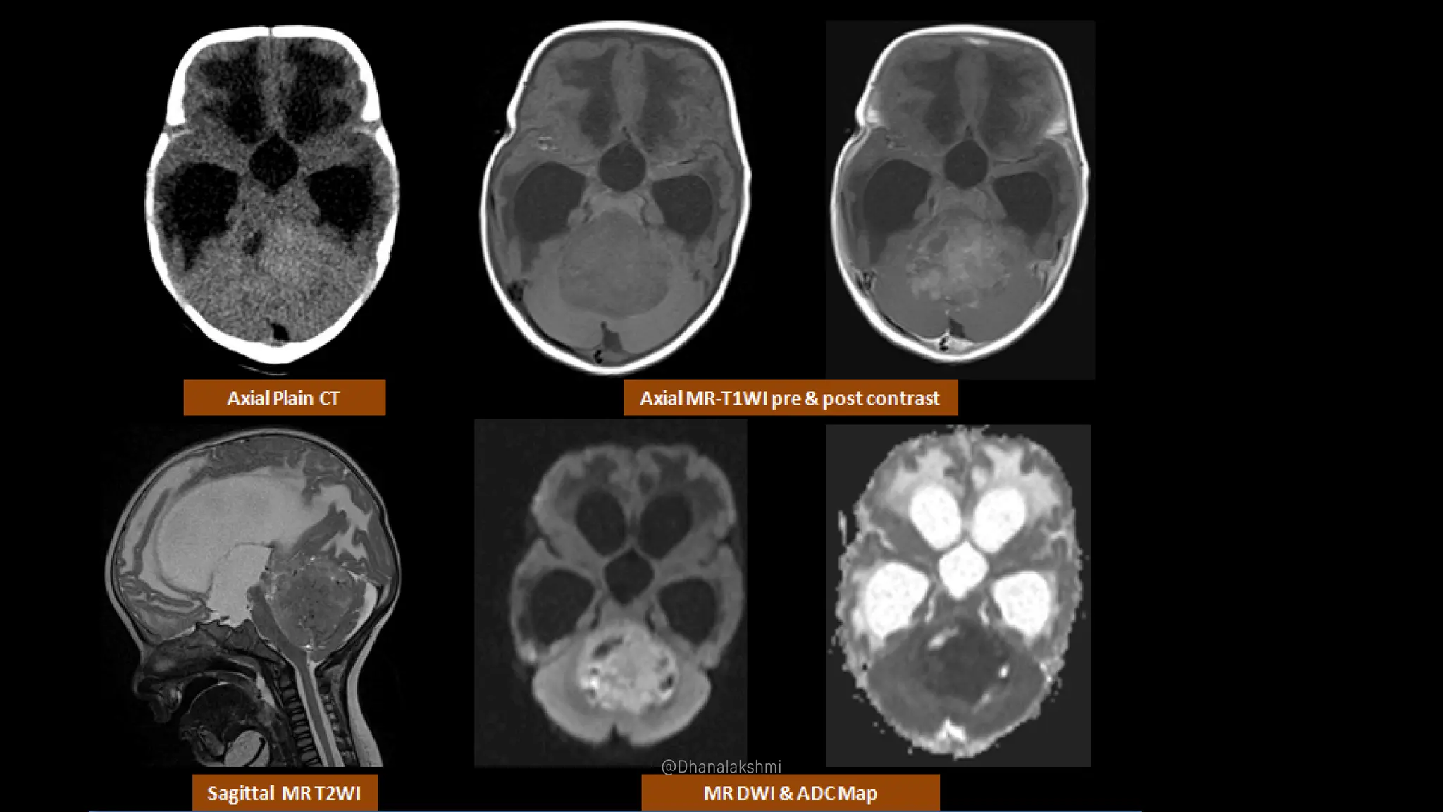 Posterior fossa tumours - Head and neck radiology pdf | PDF