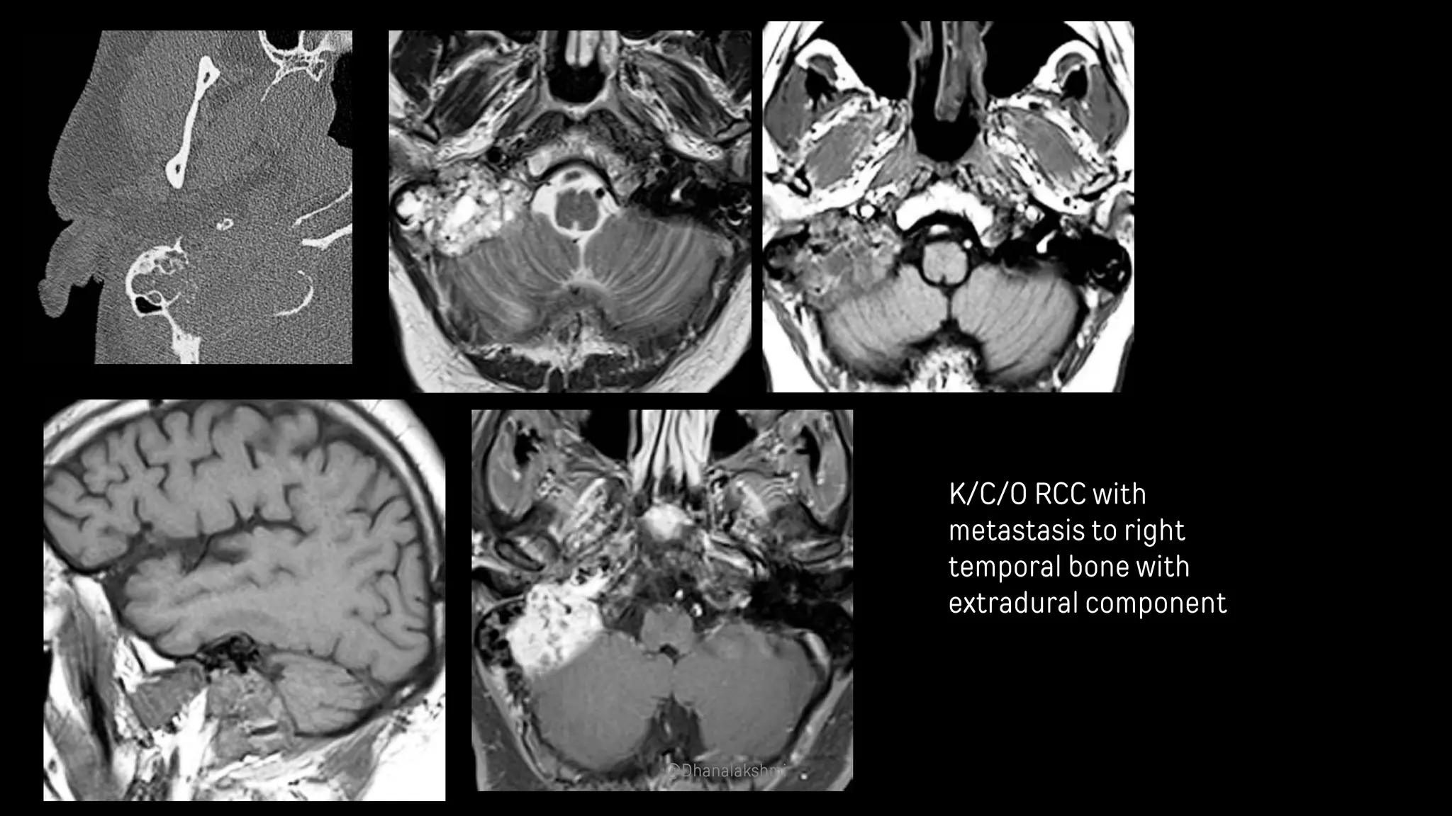 Posterior fossa tumours - Head and neck radiology pdf | PDF