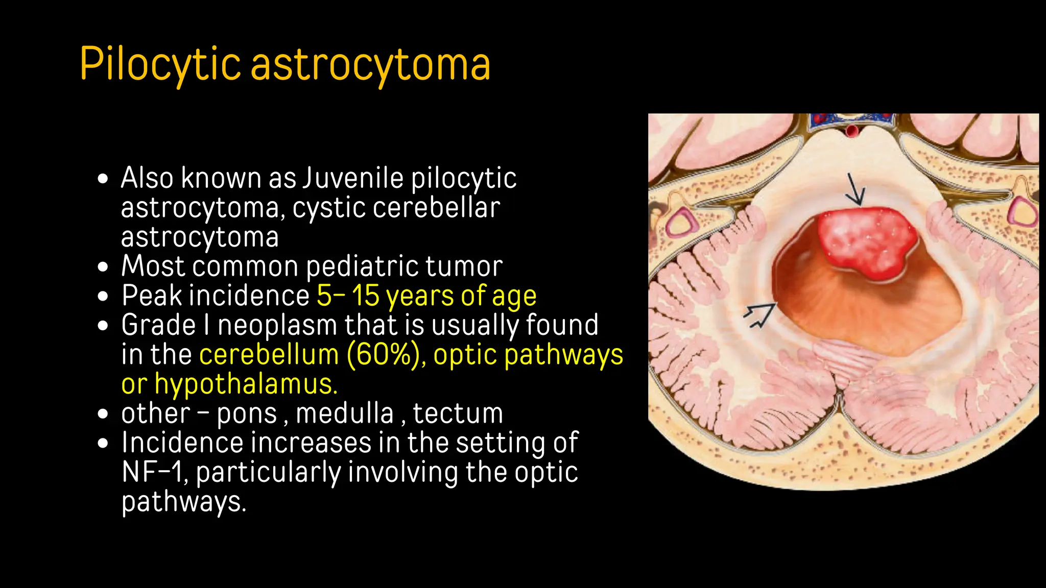 Posterior fossa tumours - Head and neck radiology pdf | PDF