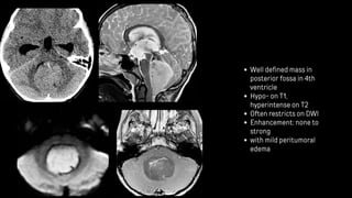 Posterior fossa tumours - Head and neck radiology pdf | PDF