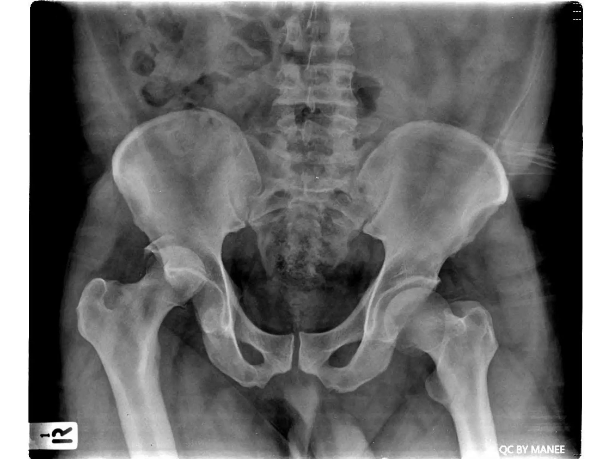 Posteriorhipdislocation | PDF