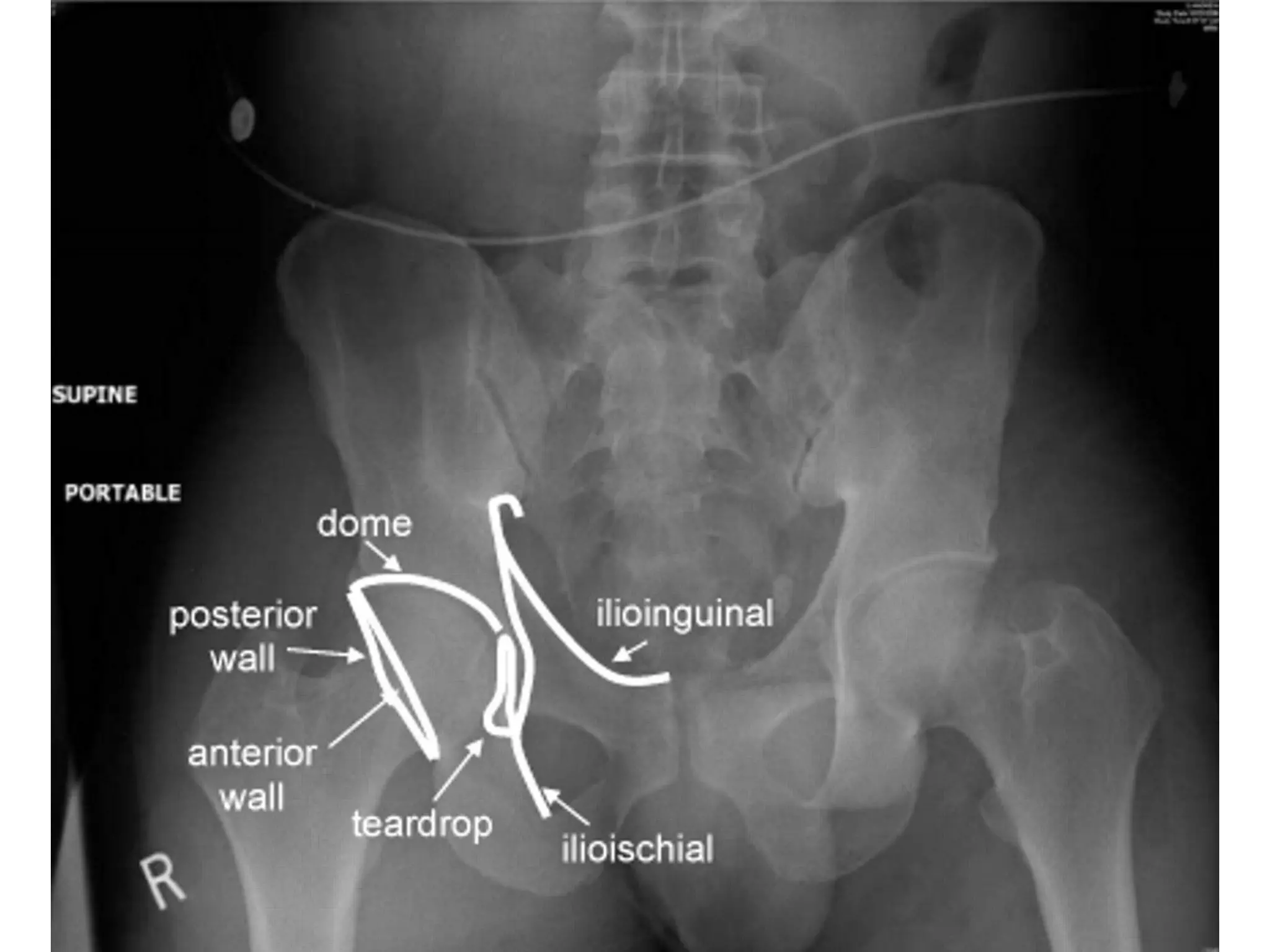 Posteriorhipdislocation | PDF