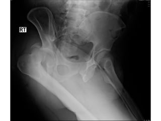 Posteriorhipdislocation | PDF