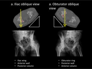 Posteriorhipdislocation | PDF
