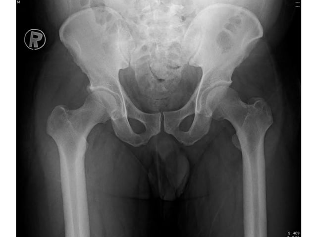 Posteriorhipdislocation | PDF | Death, Injury, or Military Conflict ...