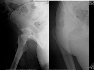 Posteriorhipdislocation | PDF