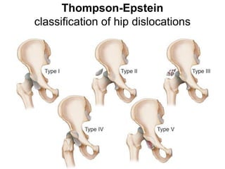 Posteriorhipdislocation | PDF