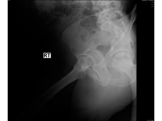 Posteriorhipdislocation | PDF