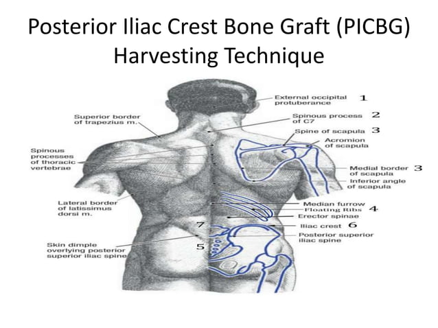 Posterior iliac crest bone graft