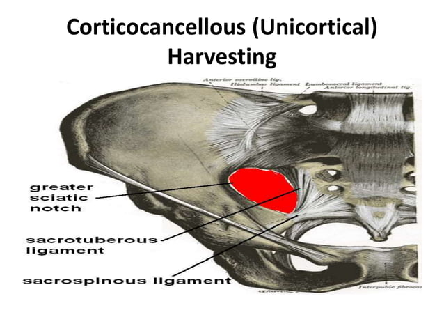 Posterior iliac crest bone graft