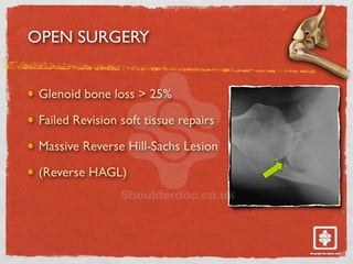 Posterior instability of the shoulder lennard funk | PDF