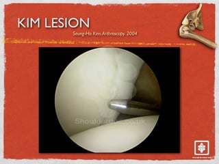 Posterior instability of the shoulder lennard funk | PDF