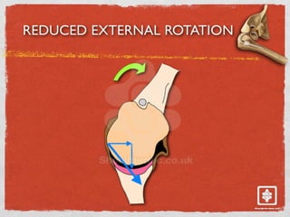 Posterior instability of the shoulder lennard funk | PDF