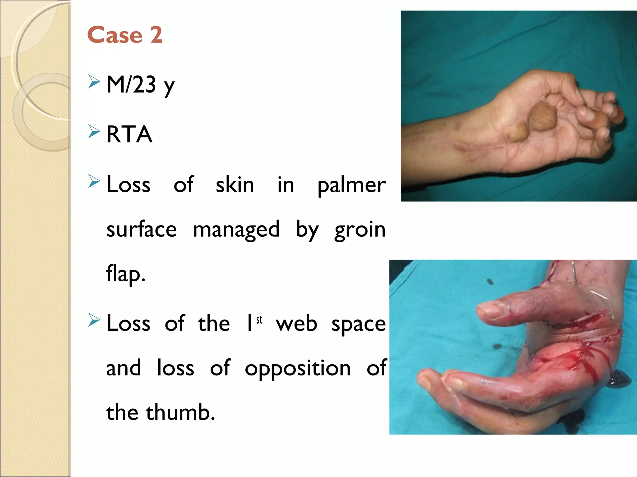 Posterior interosseous flap sosa 2018 | PPT