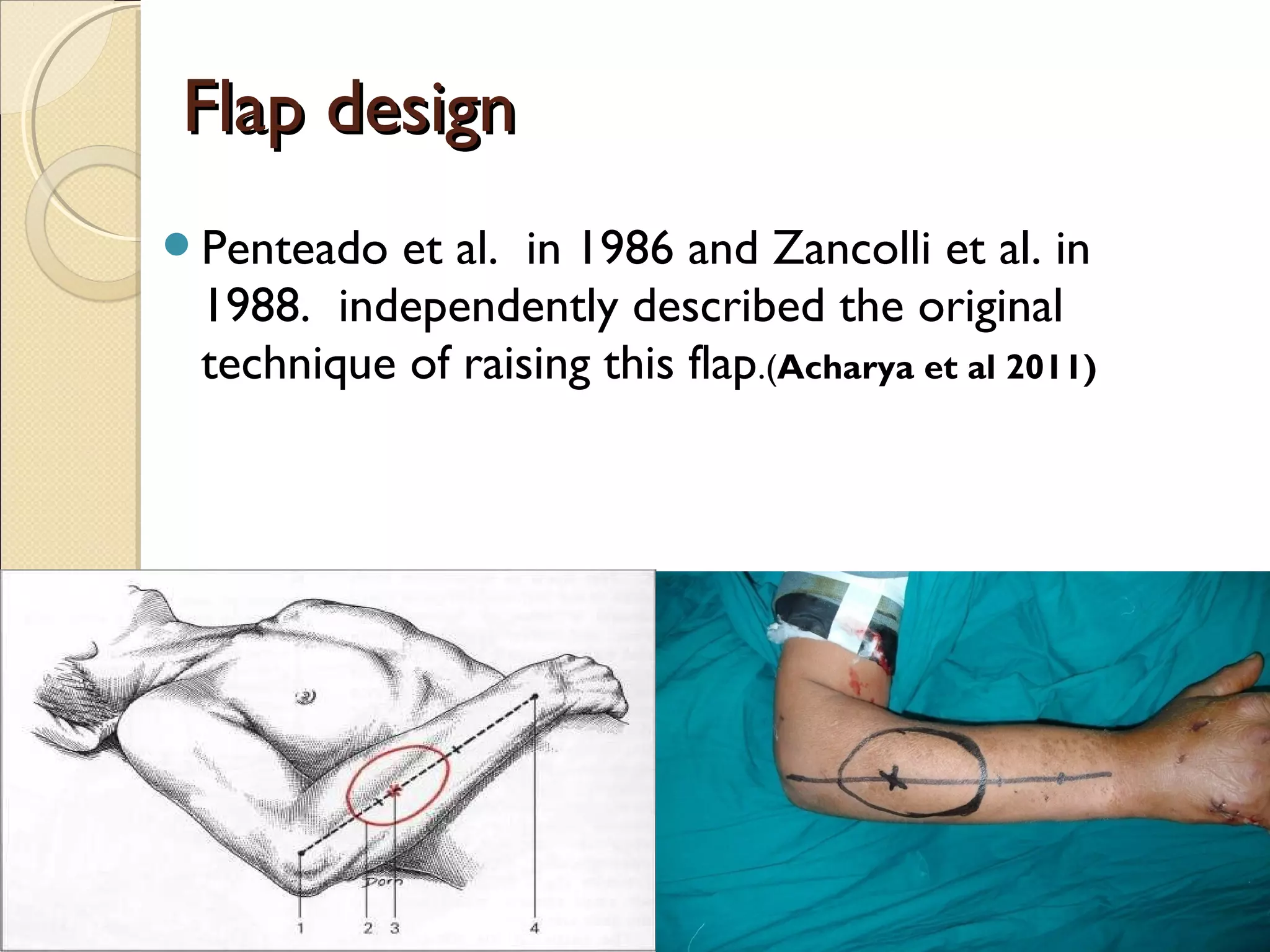 Posterior interosseous flap sosa 2018 | PPT