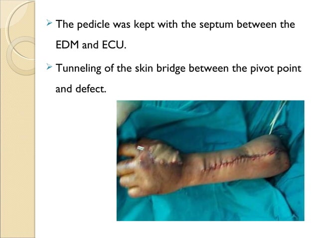 Posterior interosseous flap sosa 2018 | PPT