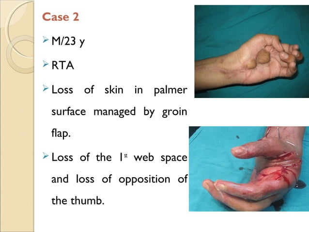 Posterior interosseous flap sosa 2018 | PPT