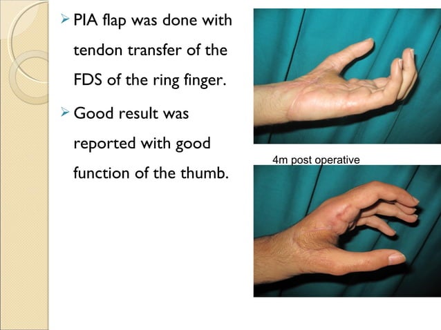 Posterior interosseous flap sosa 2018 | PPT