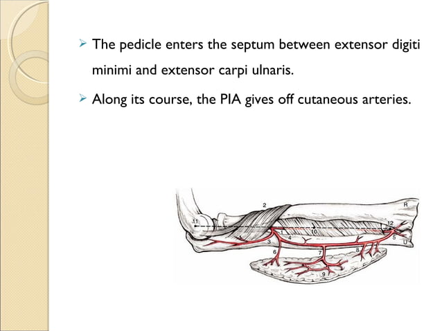 Posterior interosseous flap sosa 2018 | PPT