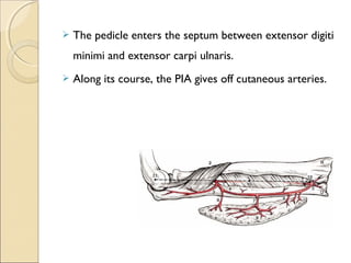 Posterior Interosseous Artery Flap