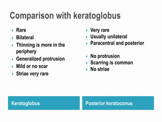 Posterior keratoconus | PPTX
