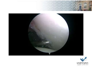 Posterior labral repair | PPT