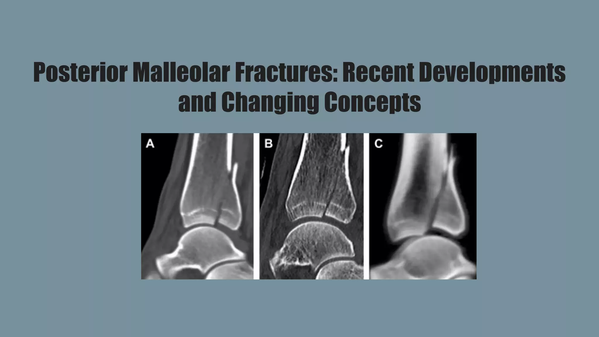 Posterior Malleolar fracture fixation | PPTX