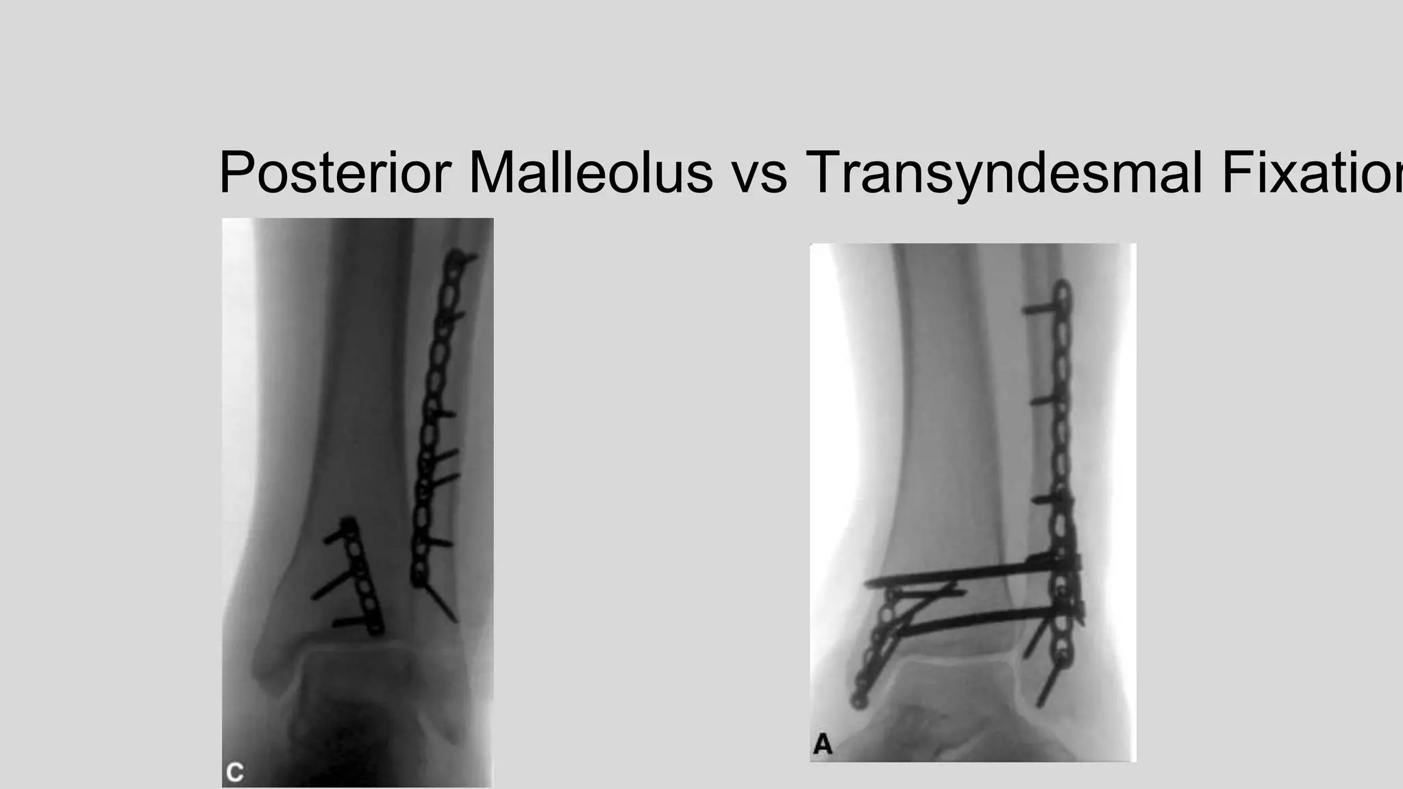 Posterior Malleolar fracture fixation | PPTX