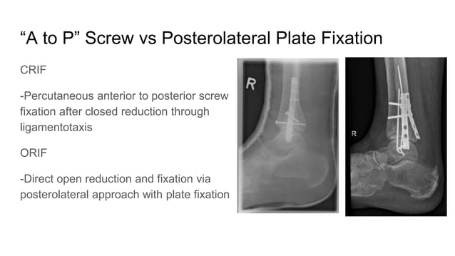 Posterior Malleolar fracture fixation | PPT
